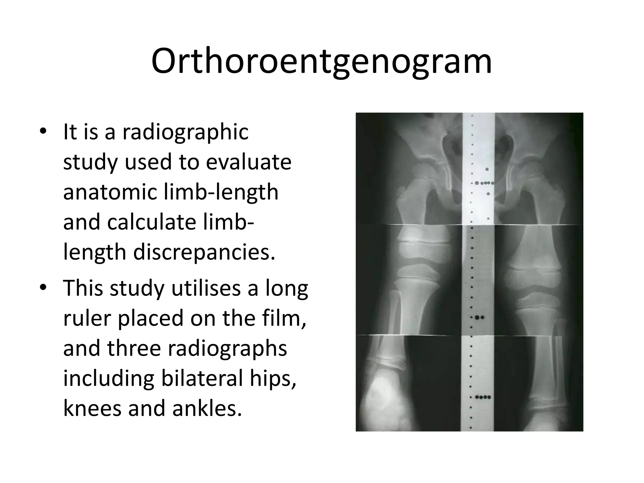 Limb length discrepancy | PPTX