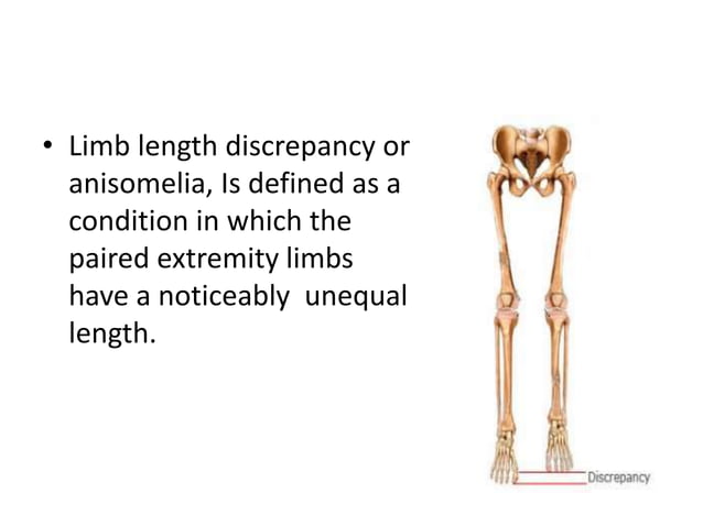 Limb length discrepancy | PPTX
