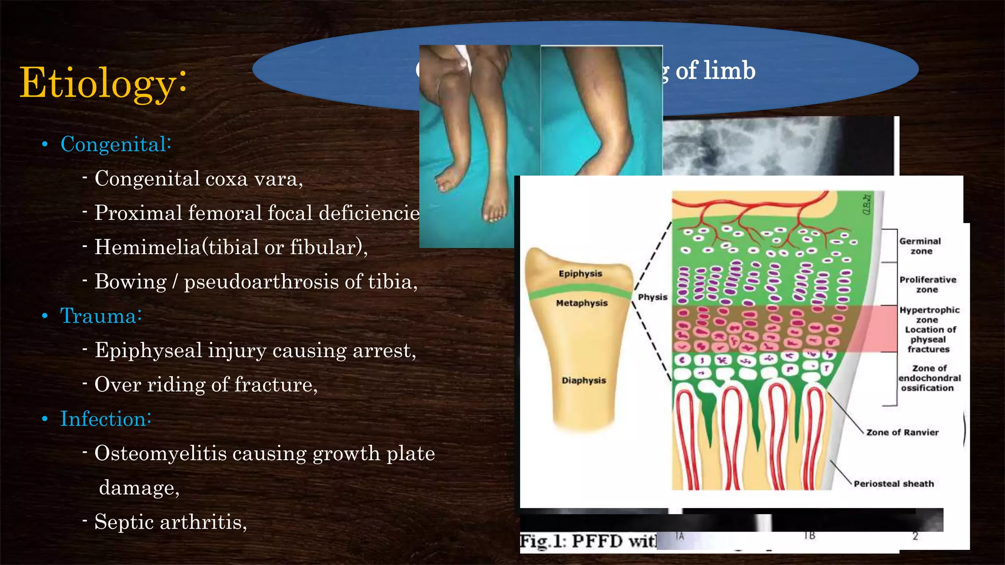 Limb length discrepancy | PPTX