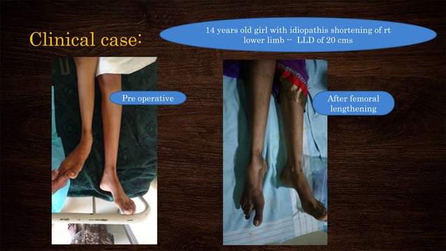 Limb length discrepancy | PPT