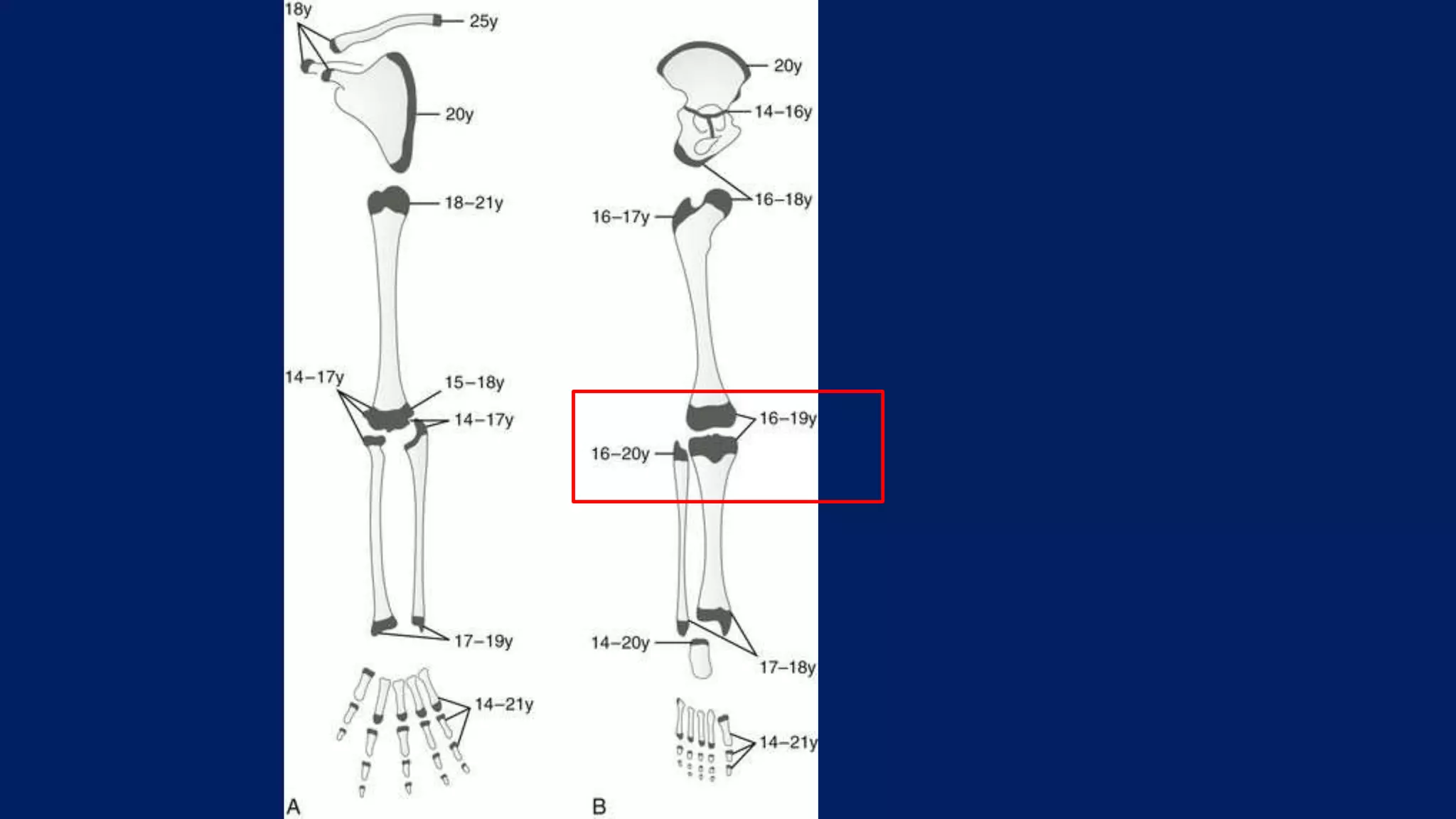 Limb length discrepancy | PPTX