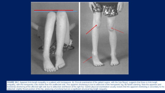 Limb length discrepancy | PPTX