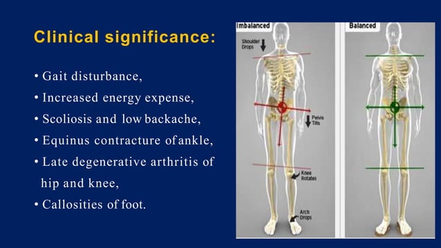Limb length discrepancy | PPTX