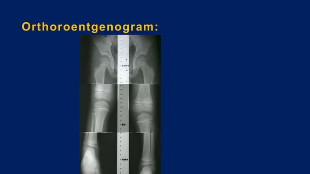 Limb length discrepancy | PPTX