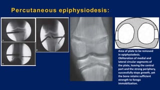 Limb length discrepancy | PPTX