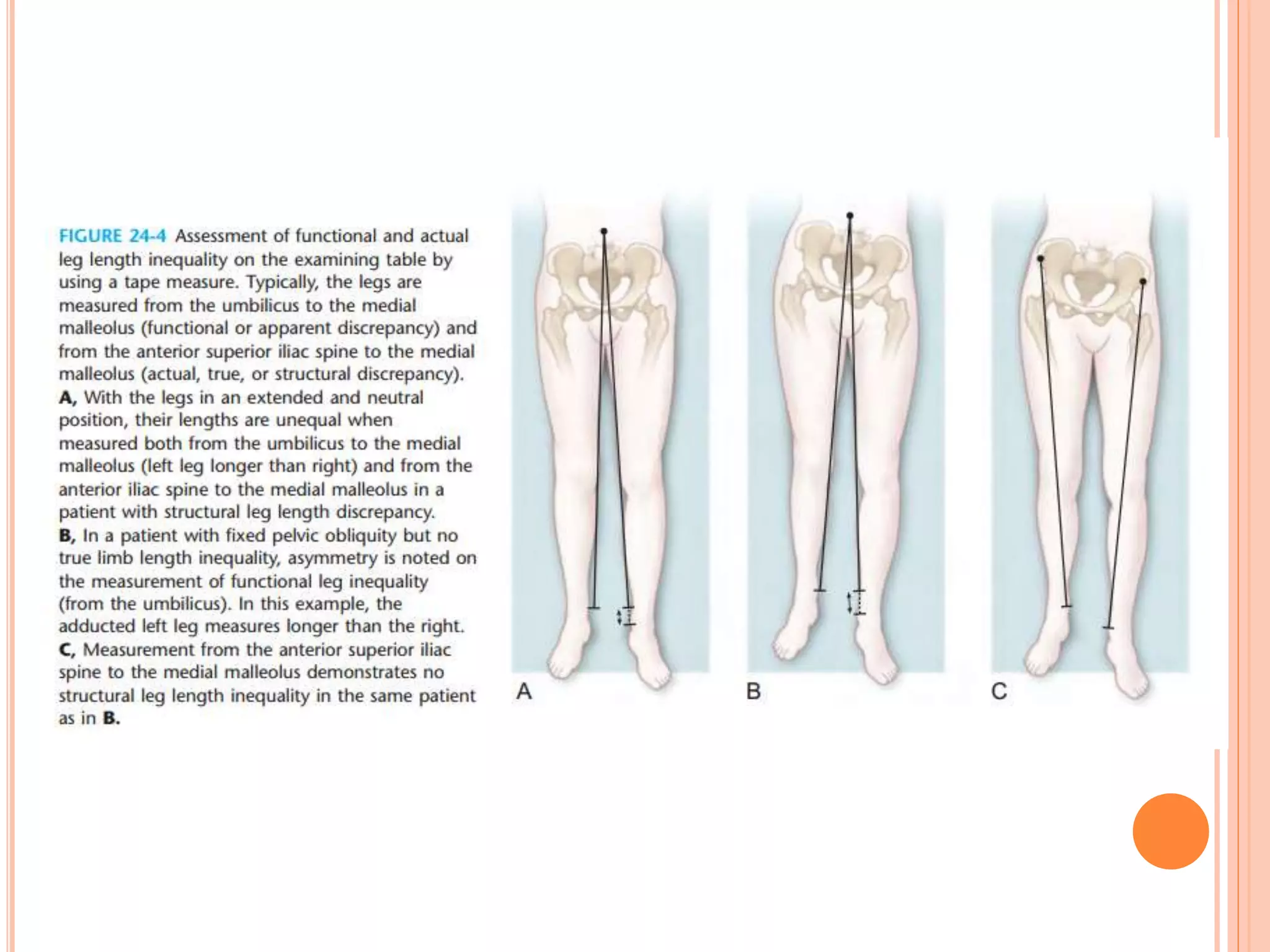 Limb length discrepancy | PPTX