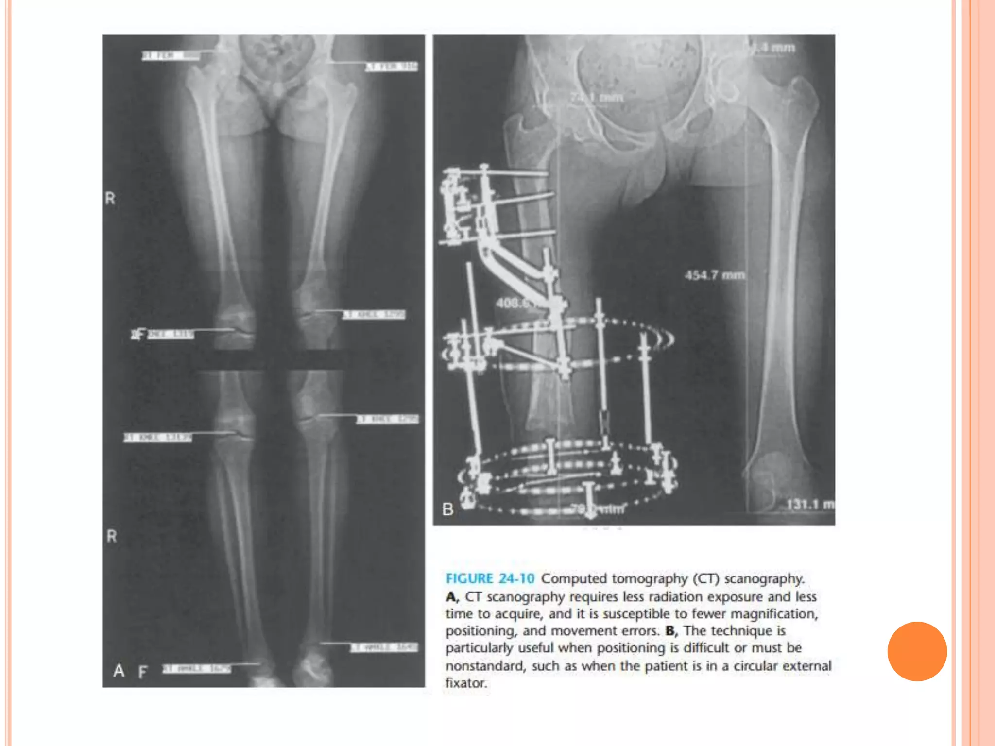 Limb length discrepancy | PPTX