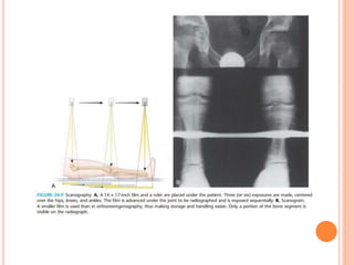 Limb length discrepancy | PPTX