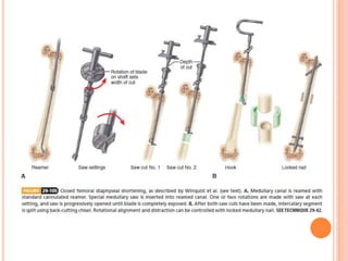 Limb length discrepancy | PPTX