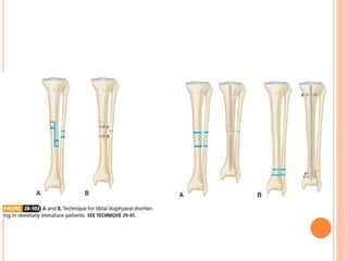 Limb length discrepancy | PPTX