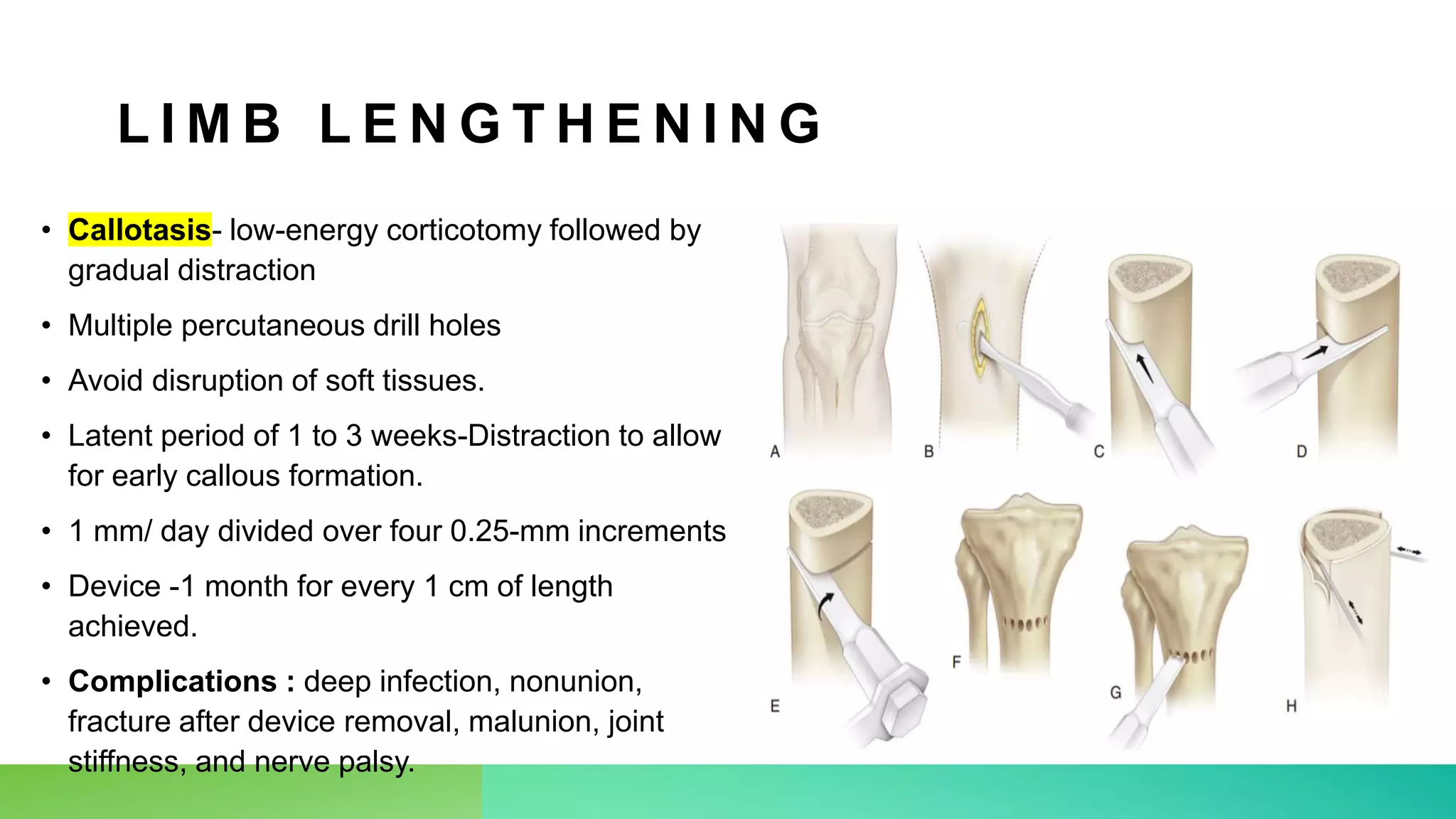 Limb Length Discrepancy.pptx