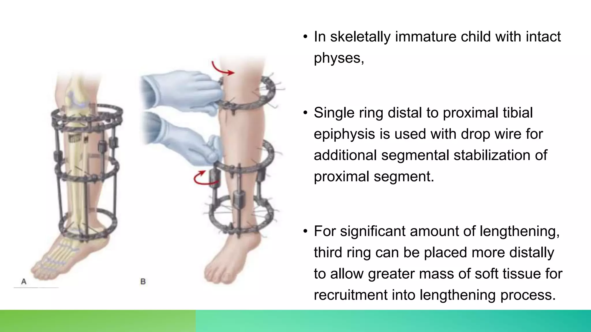 Limb Length Discrepancy.pptx