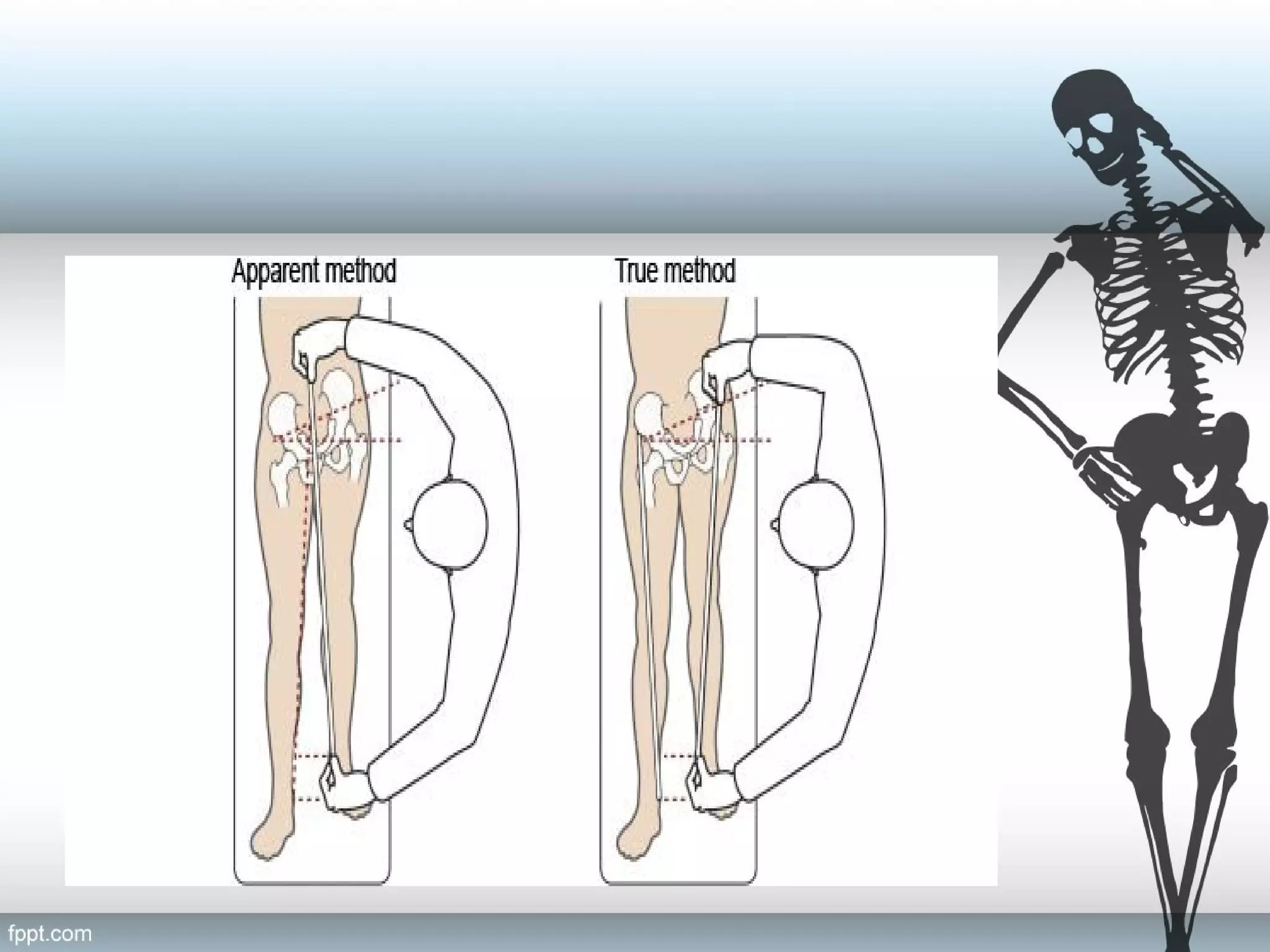 Limb length discrepency | PPT