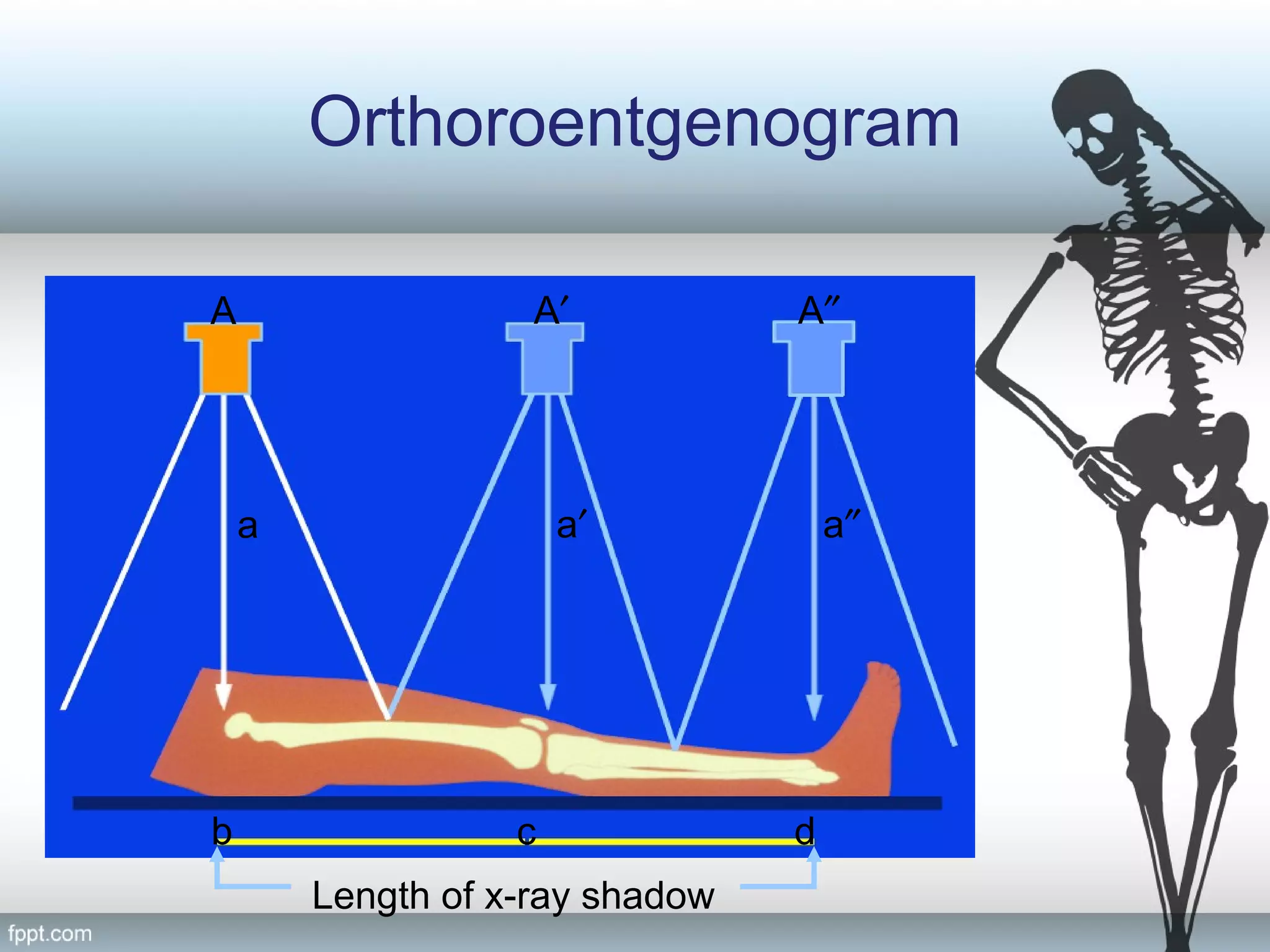 Limb length discrepency | PPT
