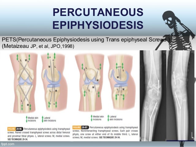 Limb length discrepency