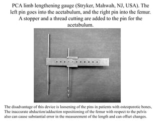 Limb length discrepency in hip arthroplasty | PPTX