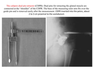 Limb length discrepency in hip arthroplasty | PPTX