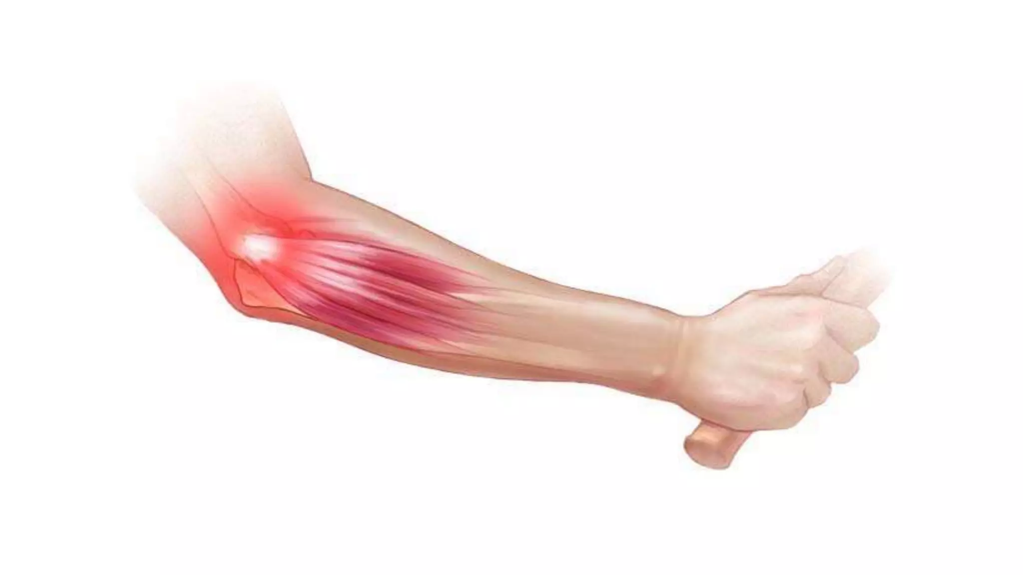 tennis elbow or lateral epicondylitis | PPT