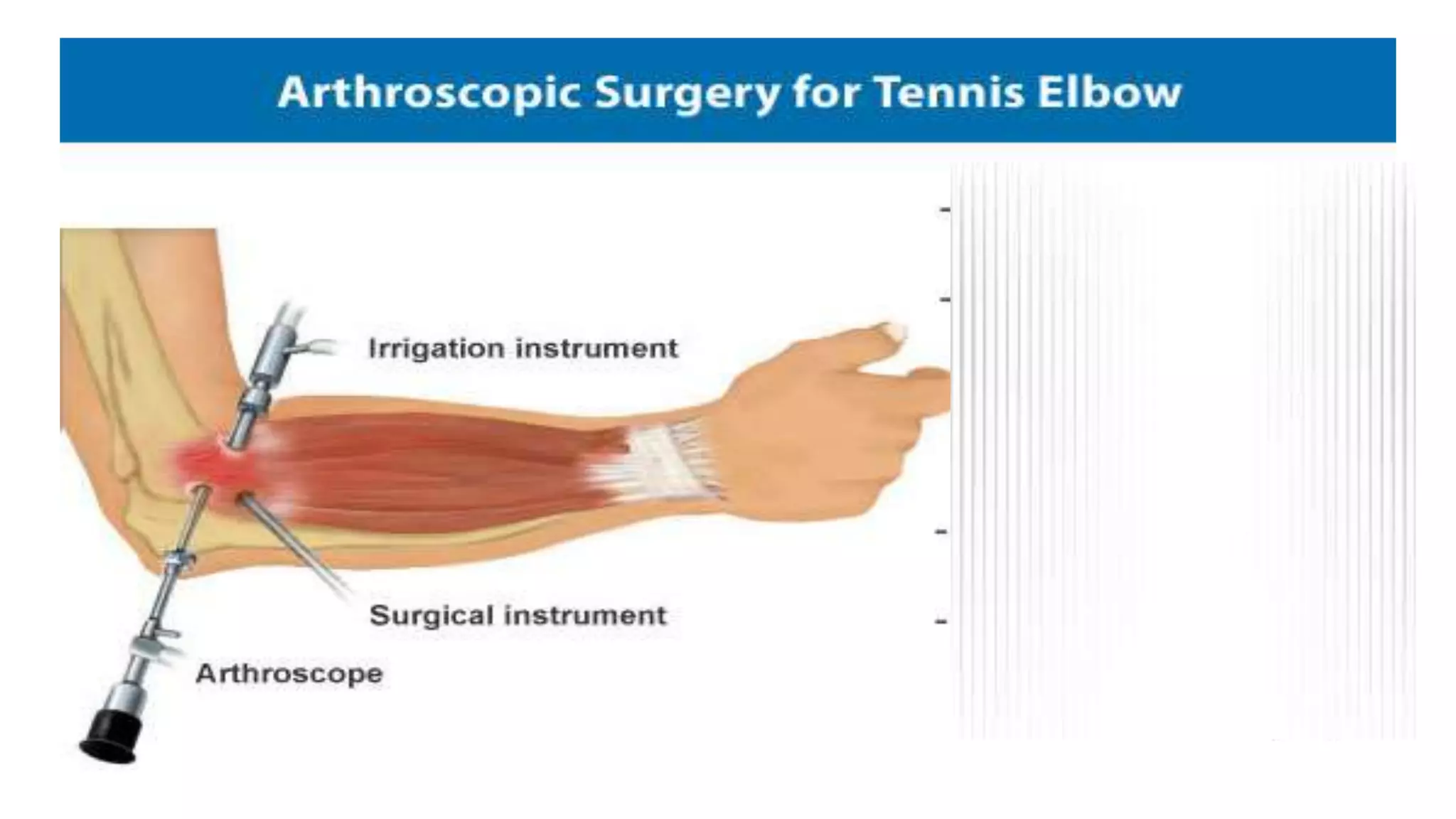 tennis elbow or lateral epicondylitis | PPTX