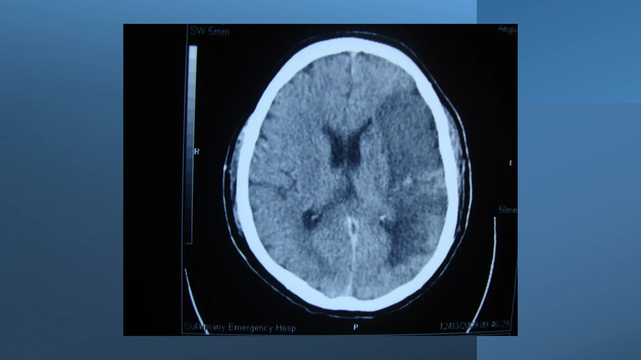 Limb Weakness (Part 1), with some clinical examples and imaging | PPTX ...