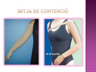 Limfedema post mastectomia | PPT