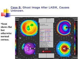 Limitations of Corneal topography | PPT