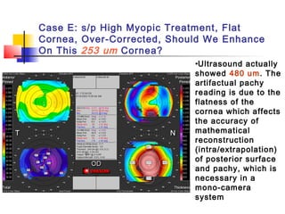 Limitations of Corneal topography | PPT