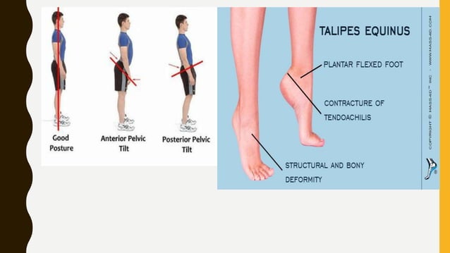 approach to Limping in pediatric | PPT