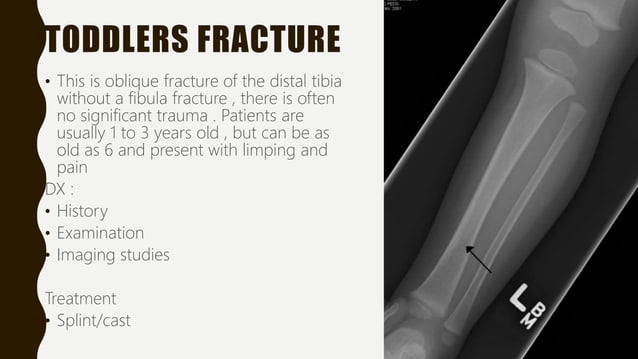 approach to Limping in pediatric | PPT