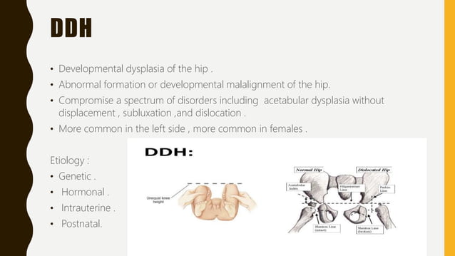 approach to Limping in pediatric | PPT