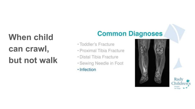Limping in child- To rule out if cause above the knee or below the knee ...