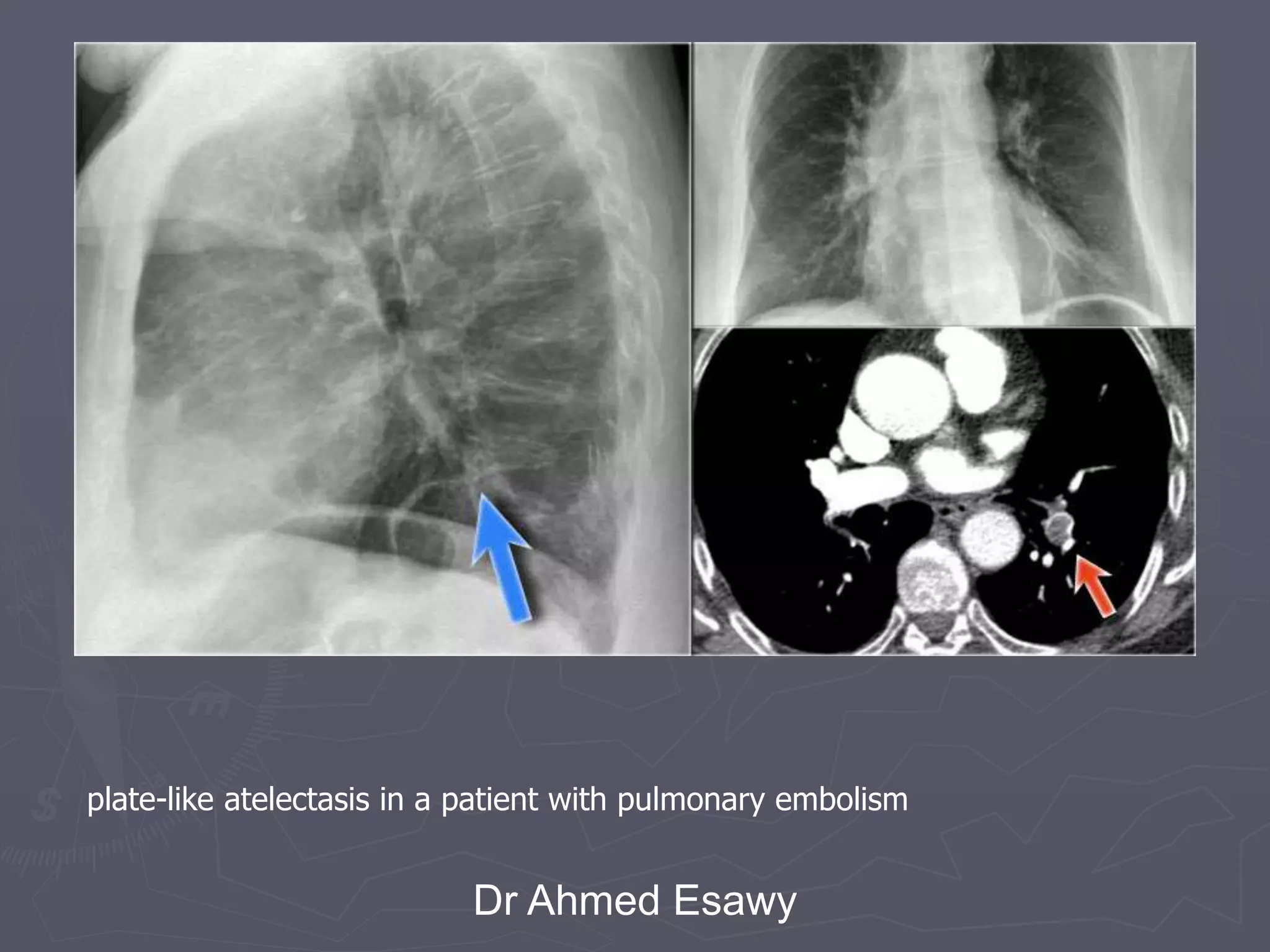 Linear lung density x ray Dr Ahmed Esawy | PDF