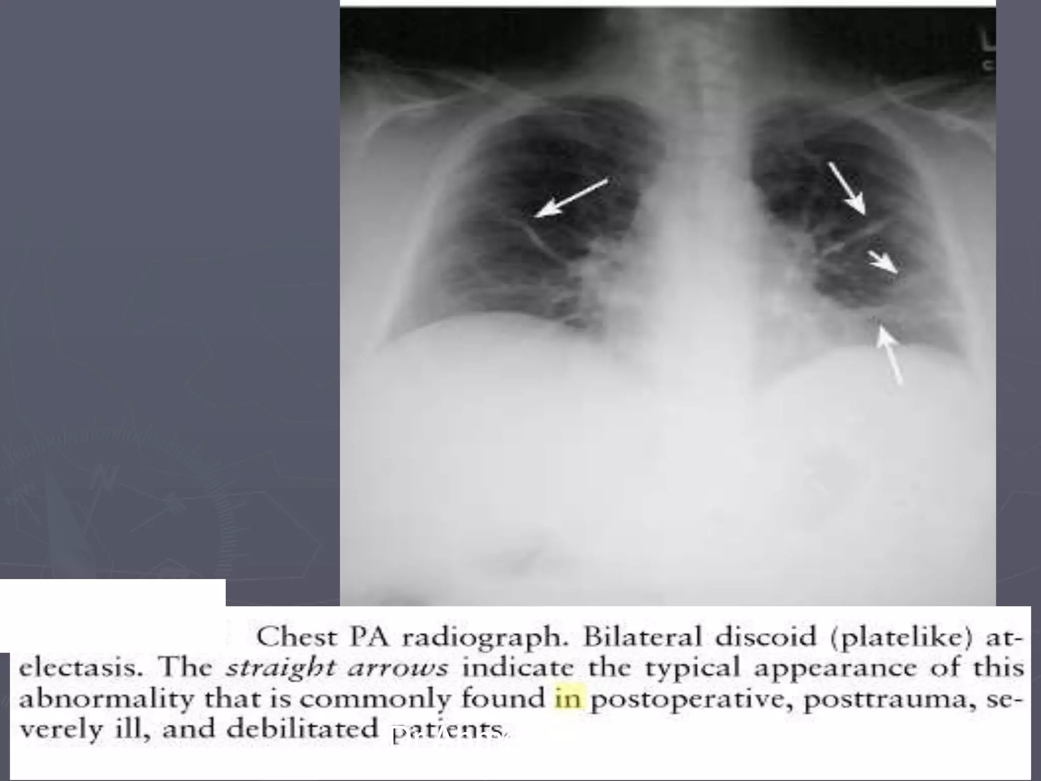 Linear lung density x ray Dr Ahmed Esawy | PDF