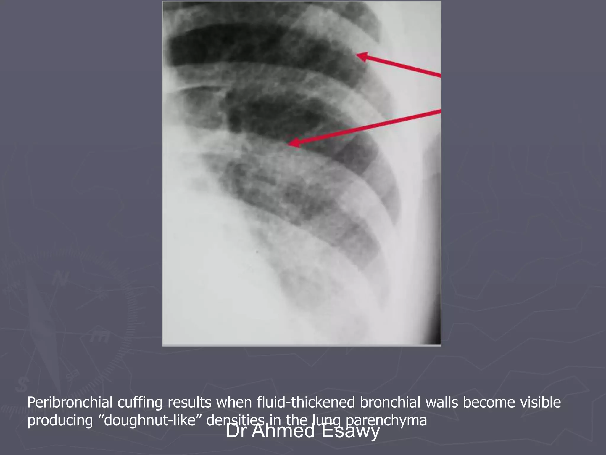 Linear lung density x ray Dr Ahmed Esawy | PDF