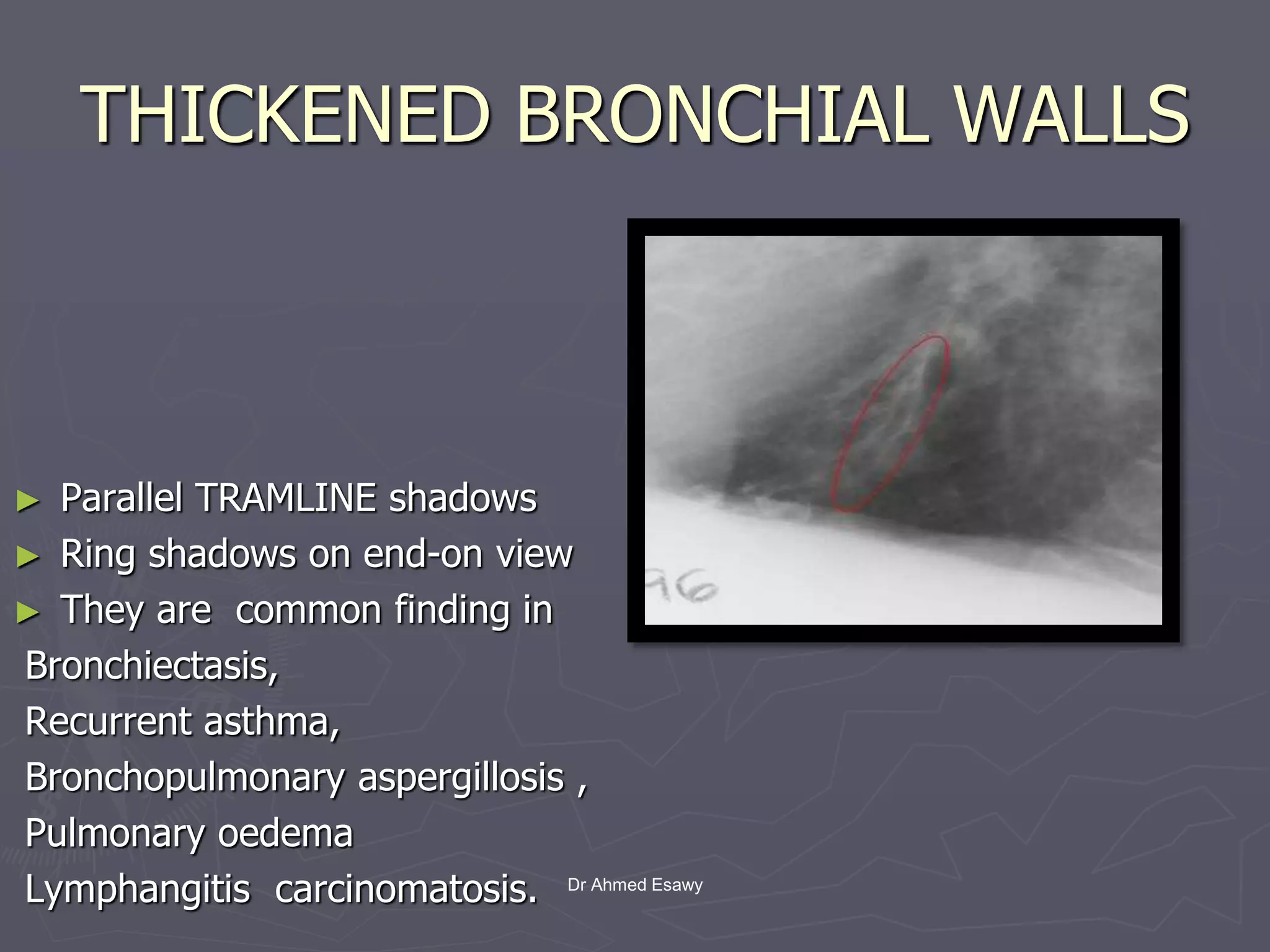 Linear lung density x ray Dr Ahmed Esawy | PDF
