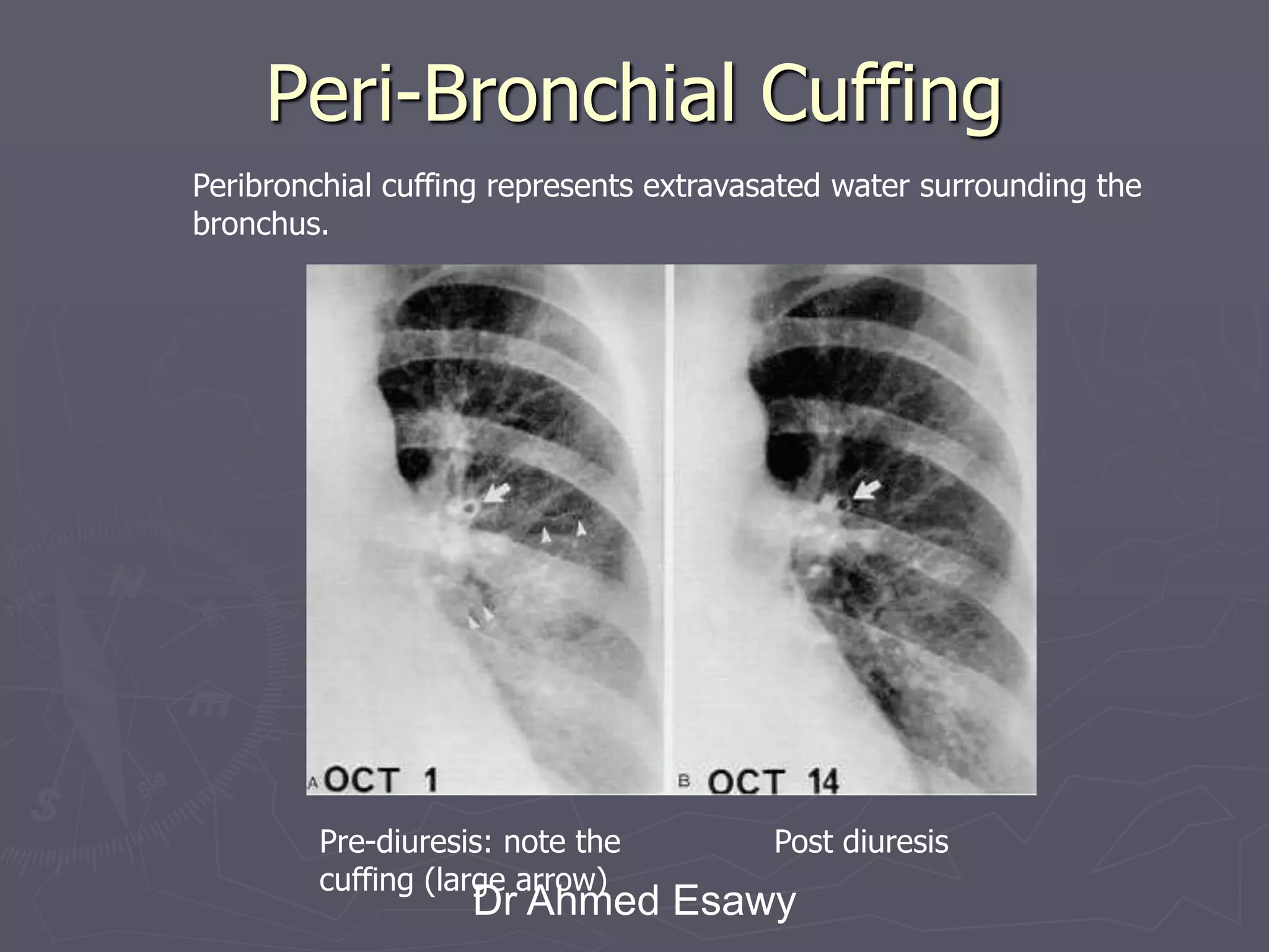 Linear lung density x ray Dr Ahmed Esawy | PDF