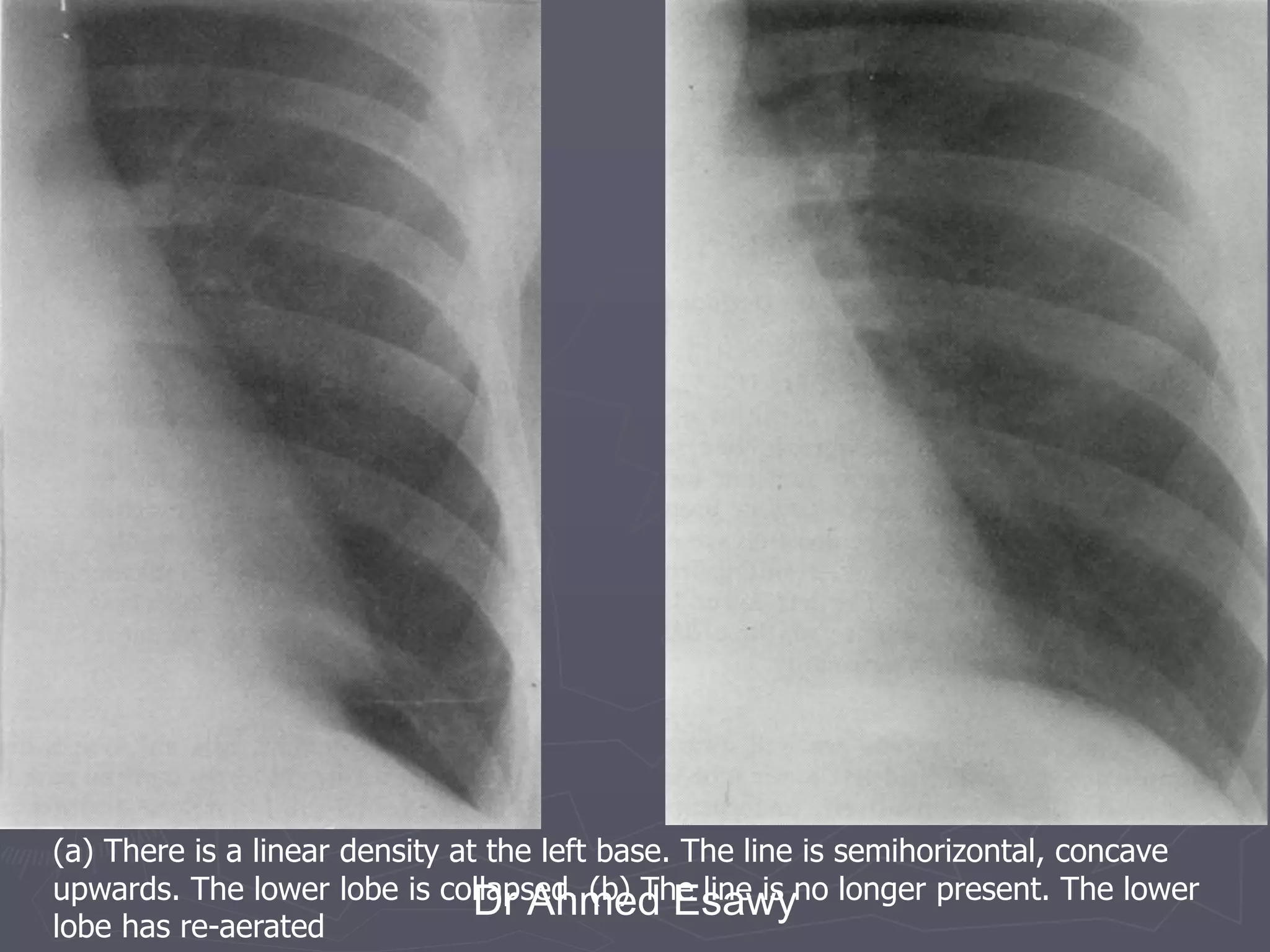 Linear lung density x ray Dr Ahmed Esawy | PDF