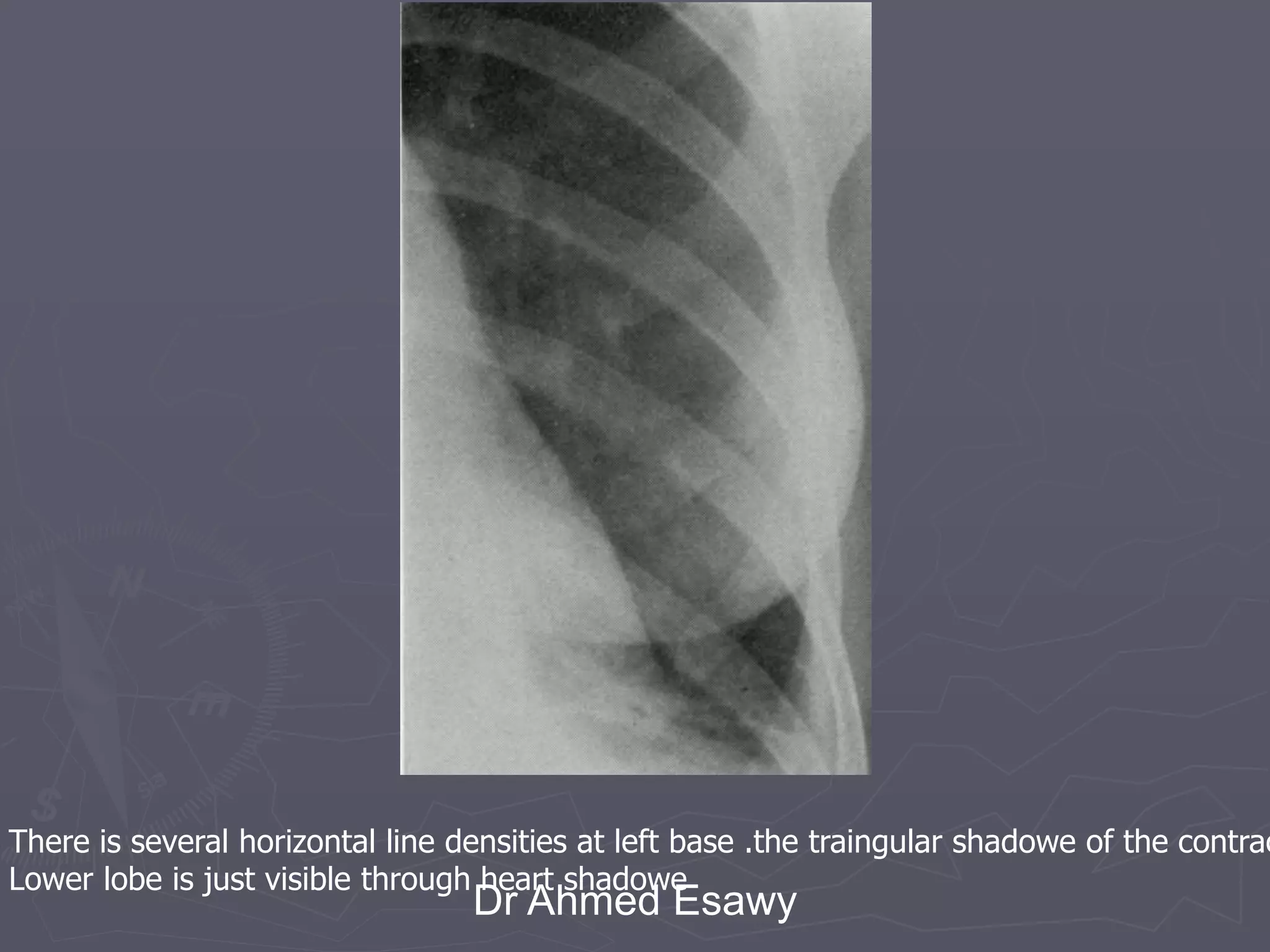 Linear lung density x ray Dr Ahmed Esawy | PDF