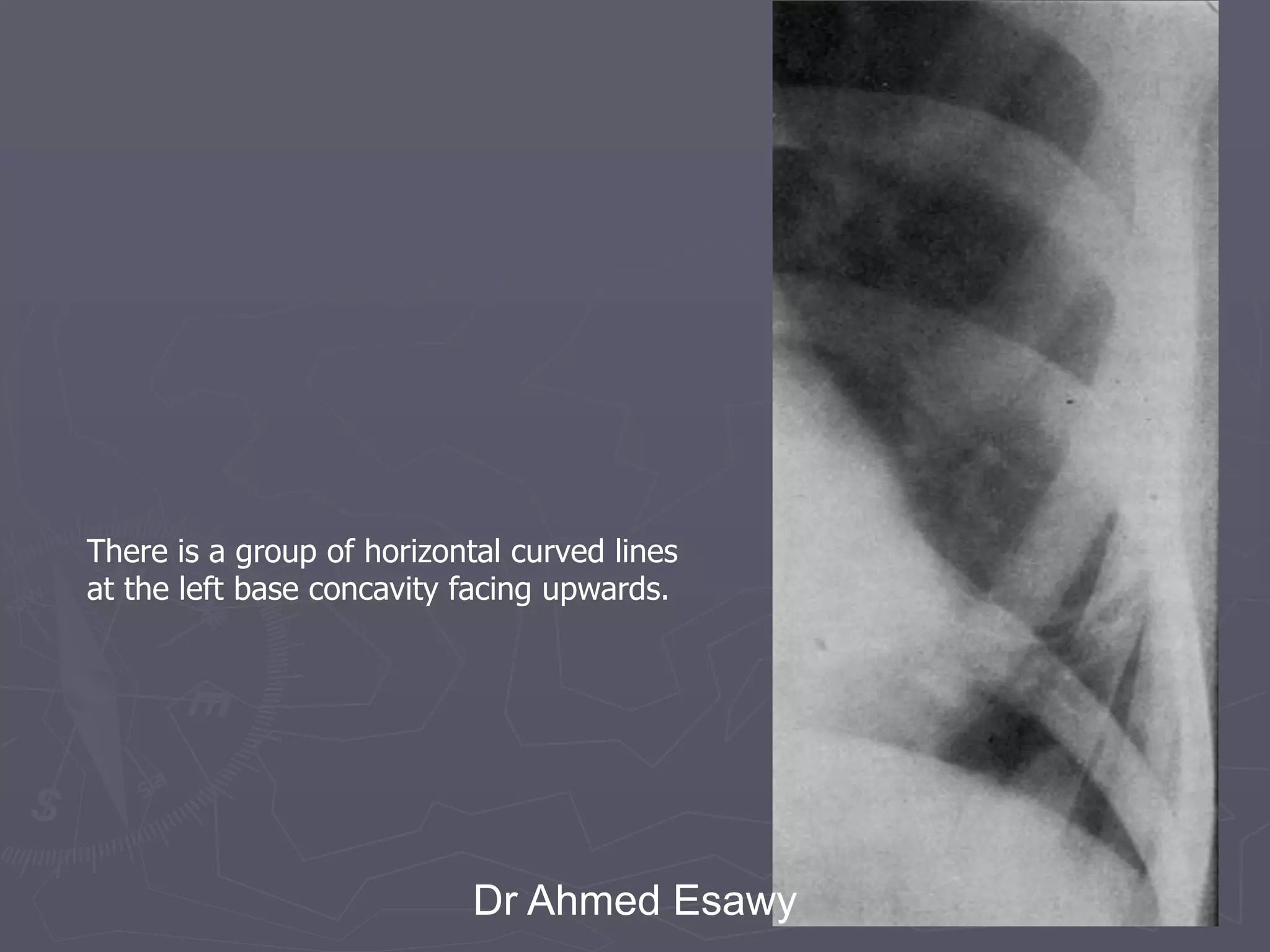 Linear lung density x ray Dr Ahmed Esawy | PDF