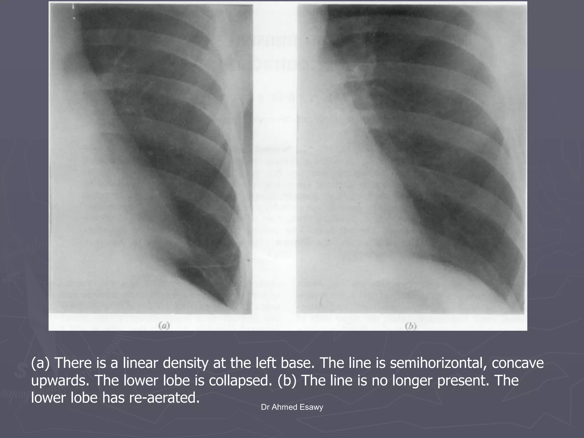 Linear lung density x ray Dr Ahmed Esawy | PDF