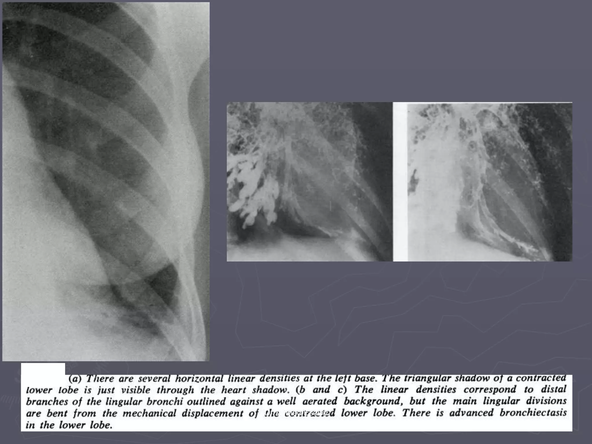 Linear lung density x ray Dr Ahmed Esawy | PDF