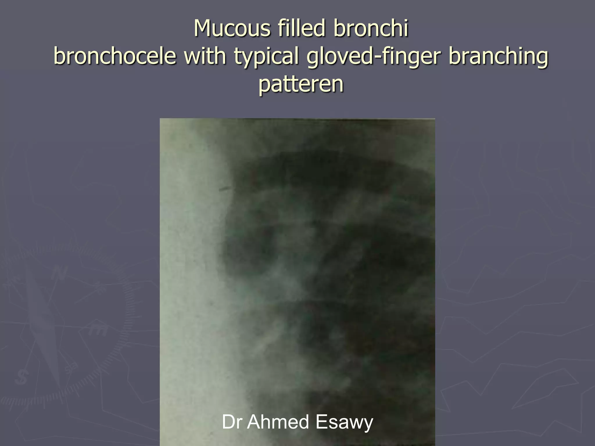 Linear lung density x ray Dr Ahmed Esawy | PDF