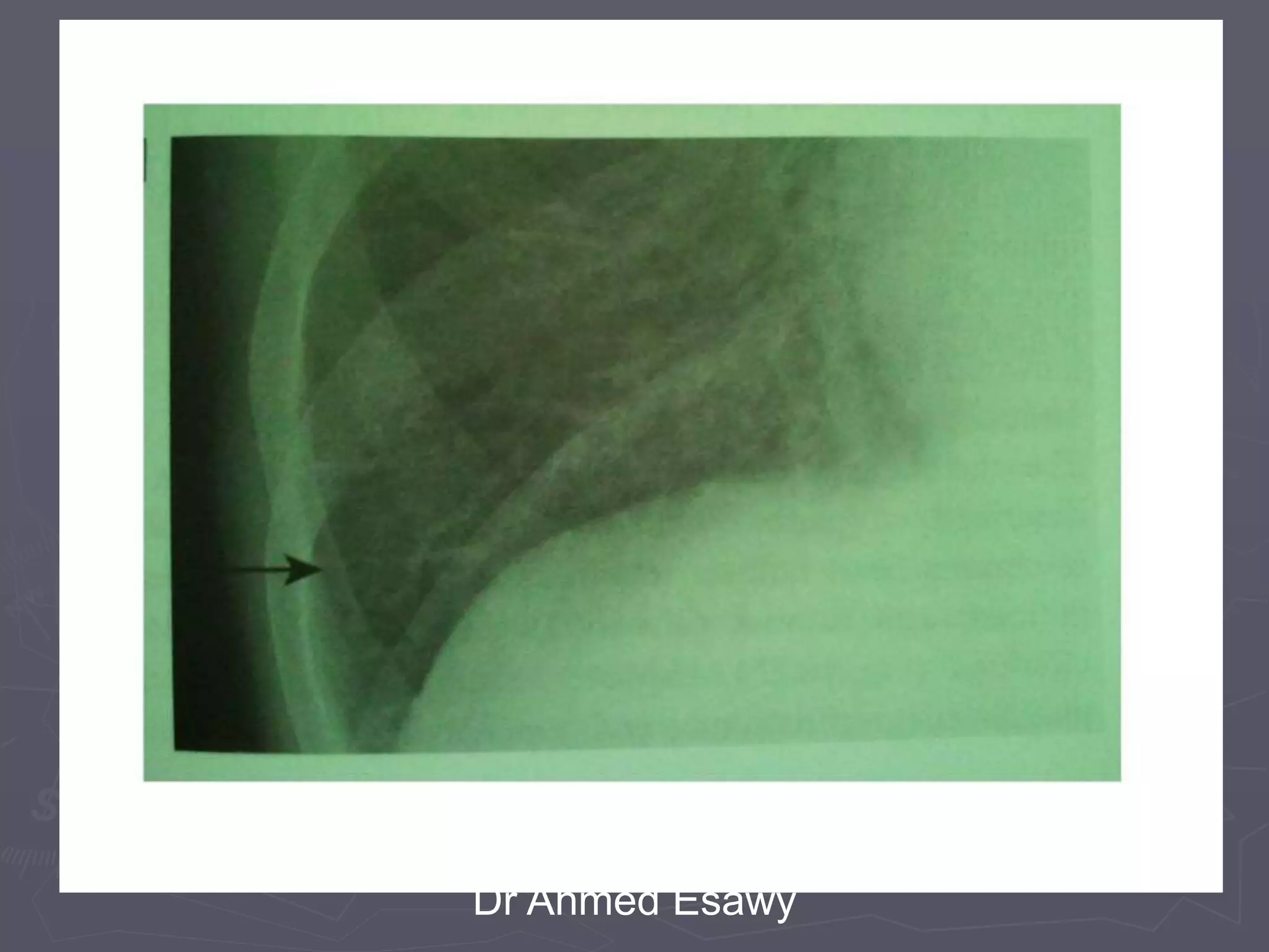 Linear lung density x ray Dr Ahmed Esawy | PDF