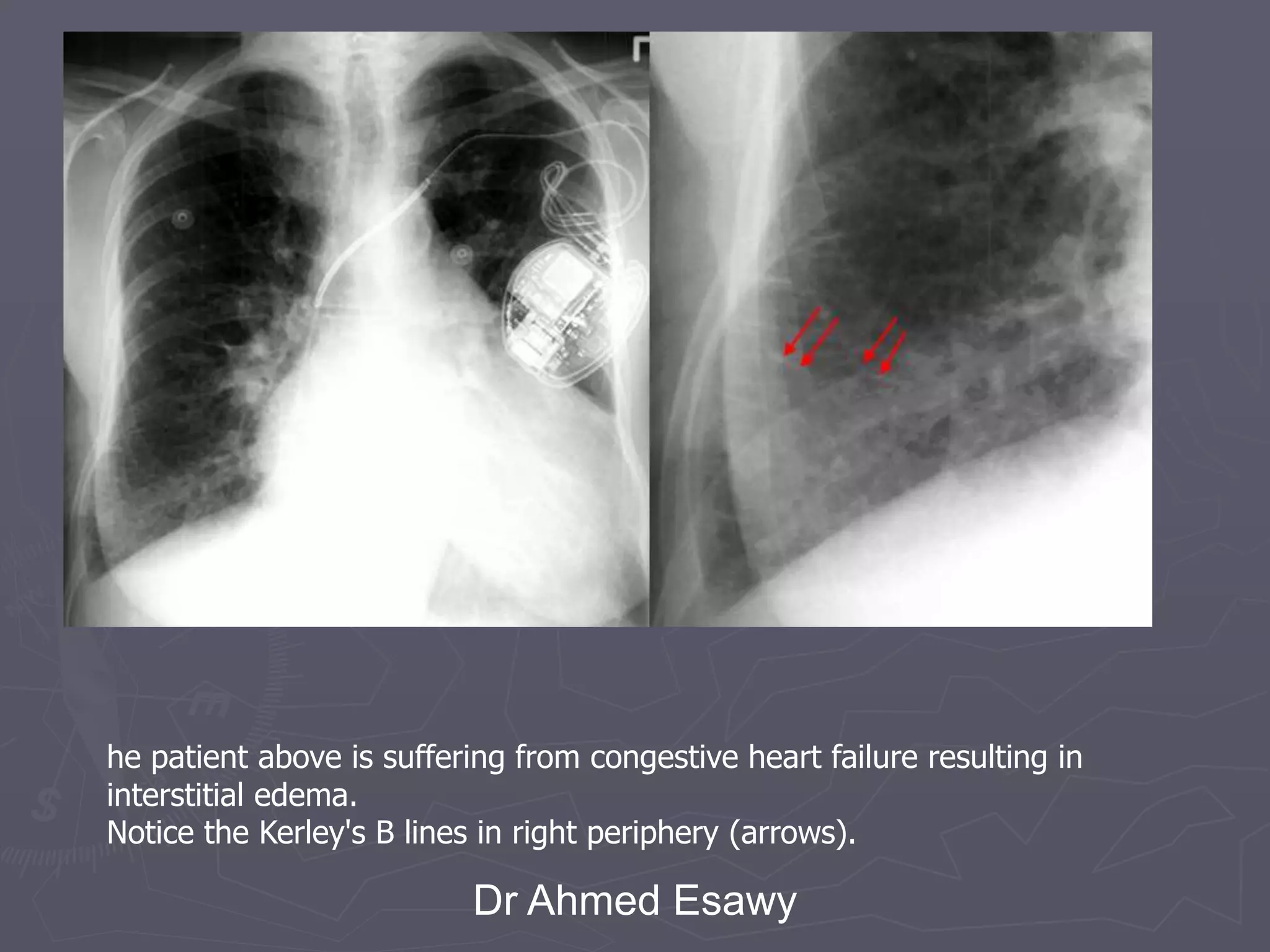 Linear lung density x ray Dr Ahmed Esawy | PDF