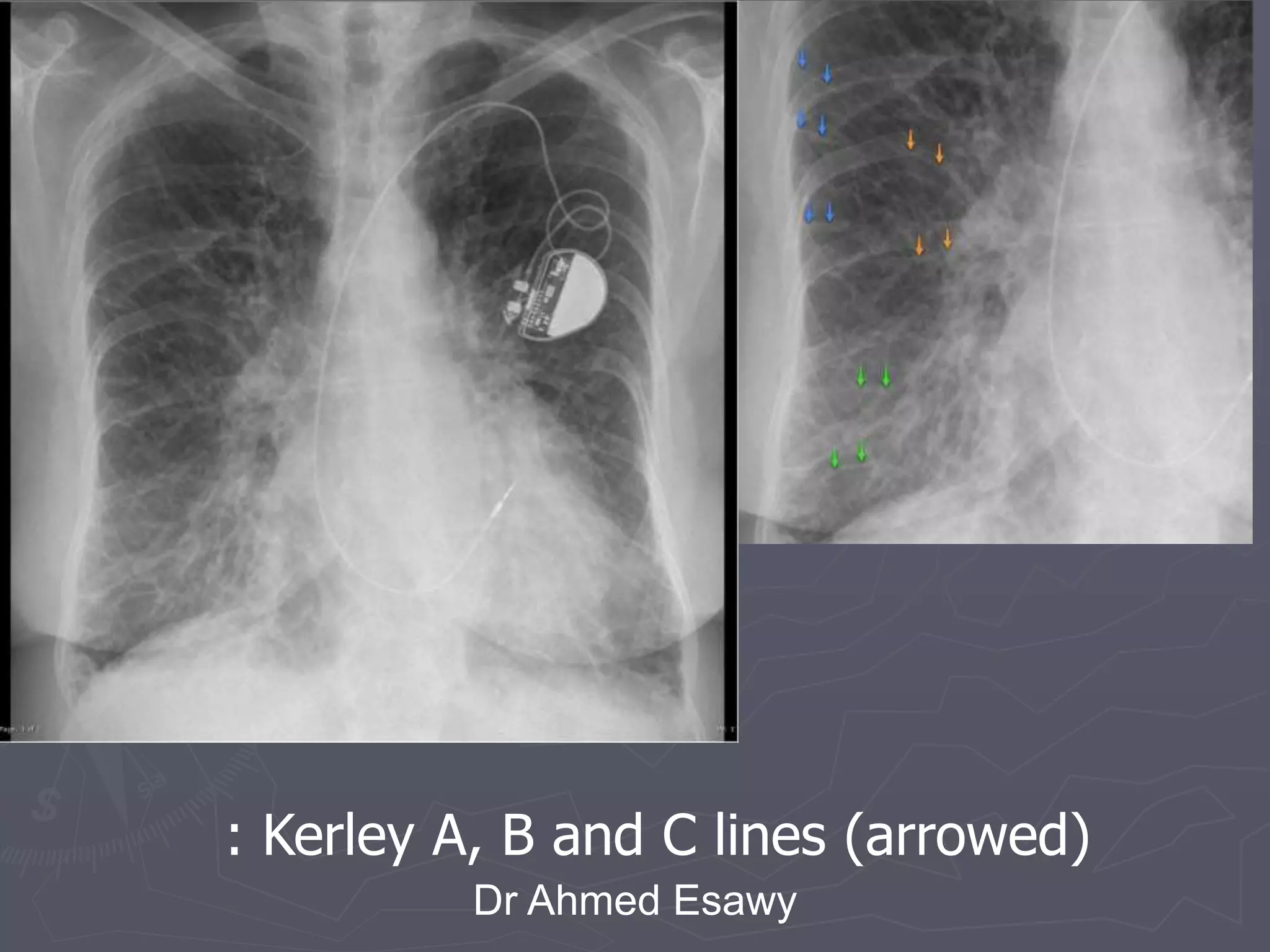 Linear lung density x ray Dr Ahmed Esawy | PDF