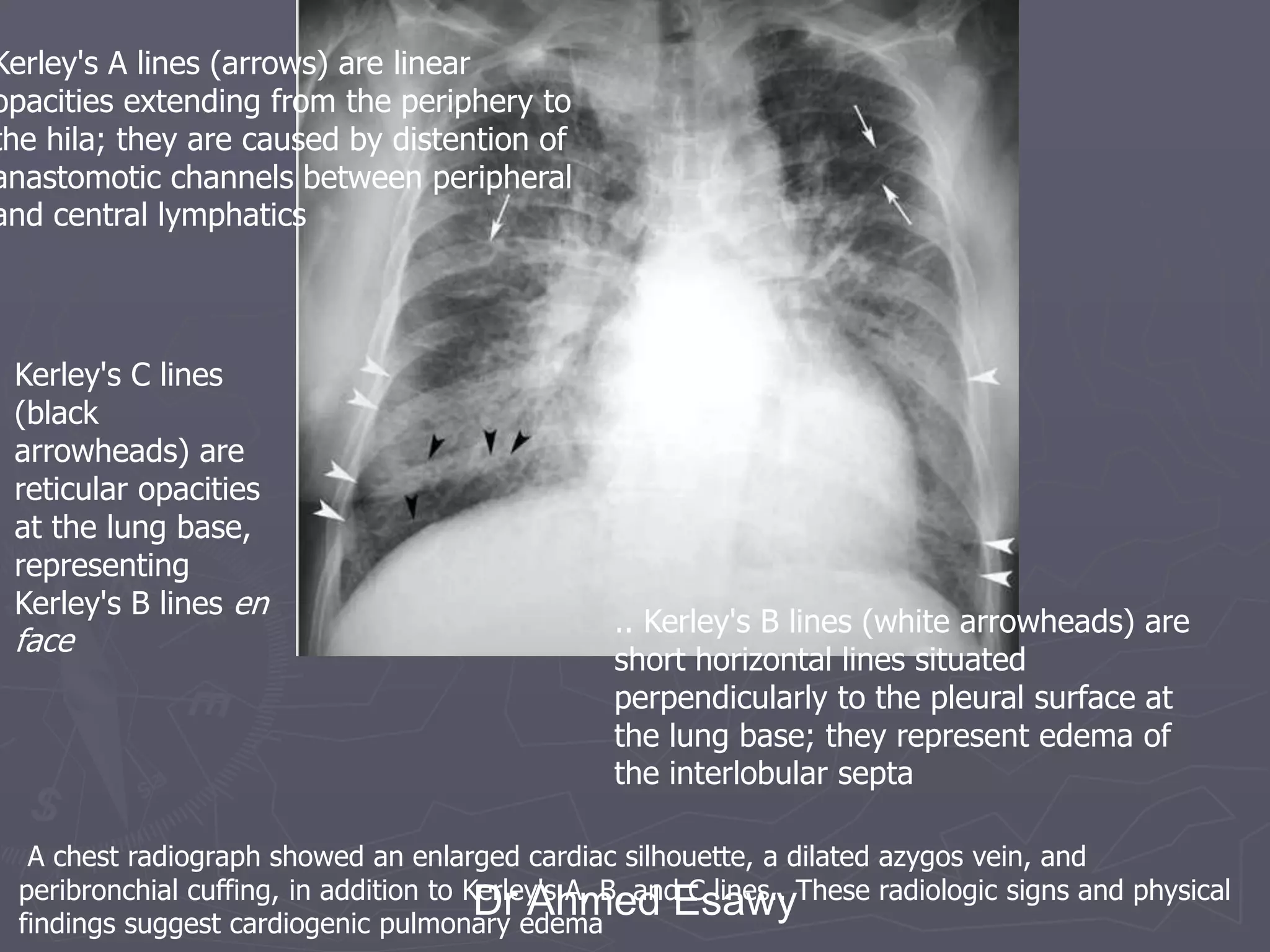 Linear lung density x ray Dr Ahmed Esawy | PDF