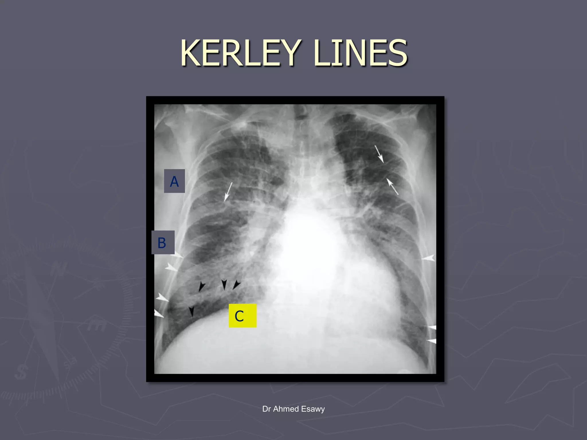 Linear lung density x ray Dr Ahmed Esawy | PDF