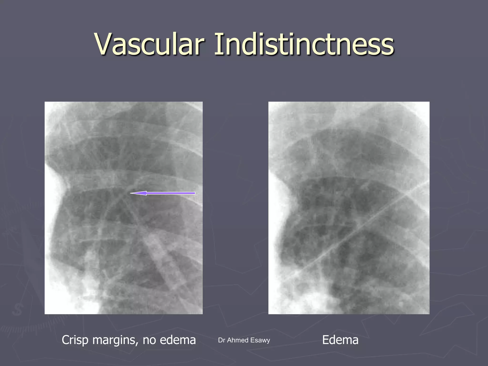 Linear lung density x ray Dr Ahmed Esawy | PDF