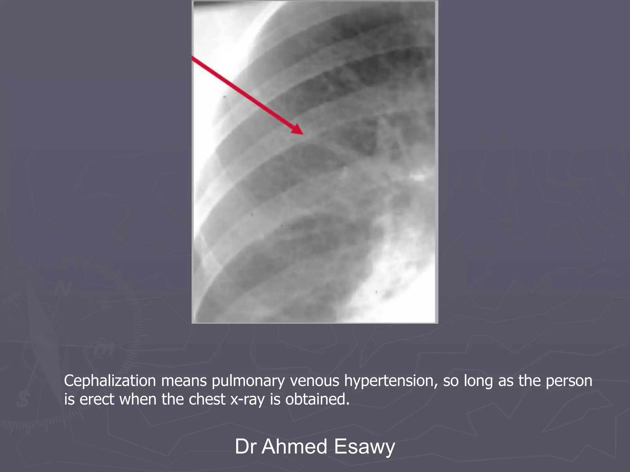 Linear lung density x ray Dr Ahmed Esawy | PDF