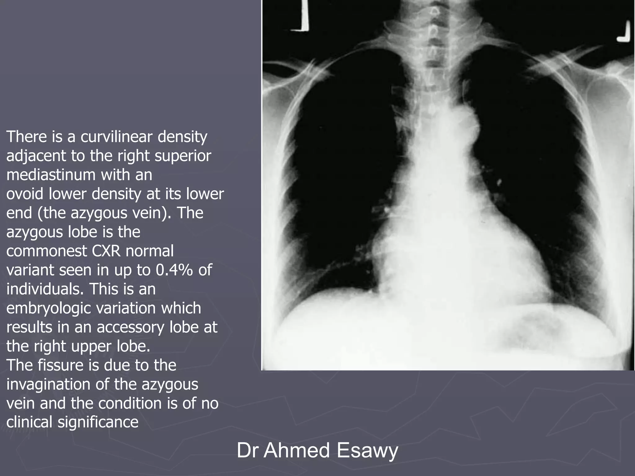 Linear lung density x ray Dr Ahmed Esawy | PDF